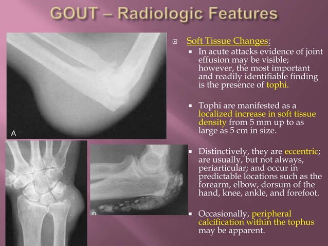 Metabolic (scurvy, gout, cppd, fluorosis) sayid | PPTX