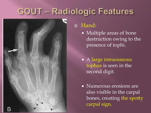 Metabolic (scurvy, gout, cppd, fluorosis) sayid | PPTX