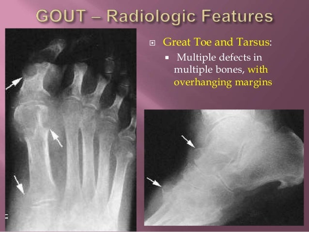 Metabolic Scurvy Gout Cppd Fluorosis Sayid