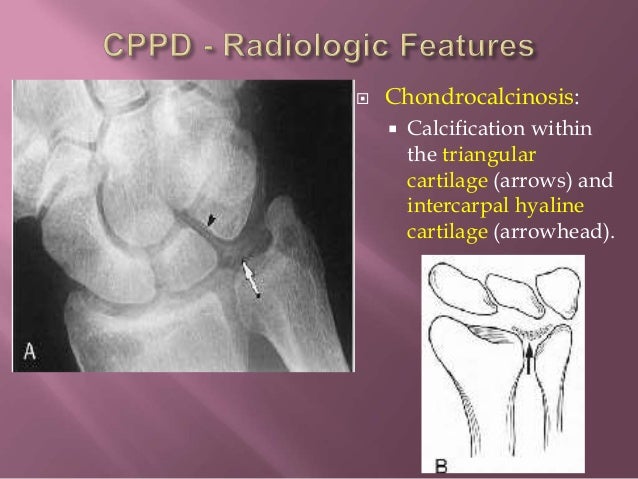 Metabolic Scurvy Gout Cppd Fluorosis Sayid