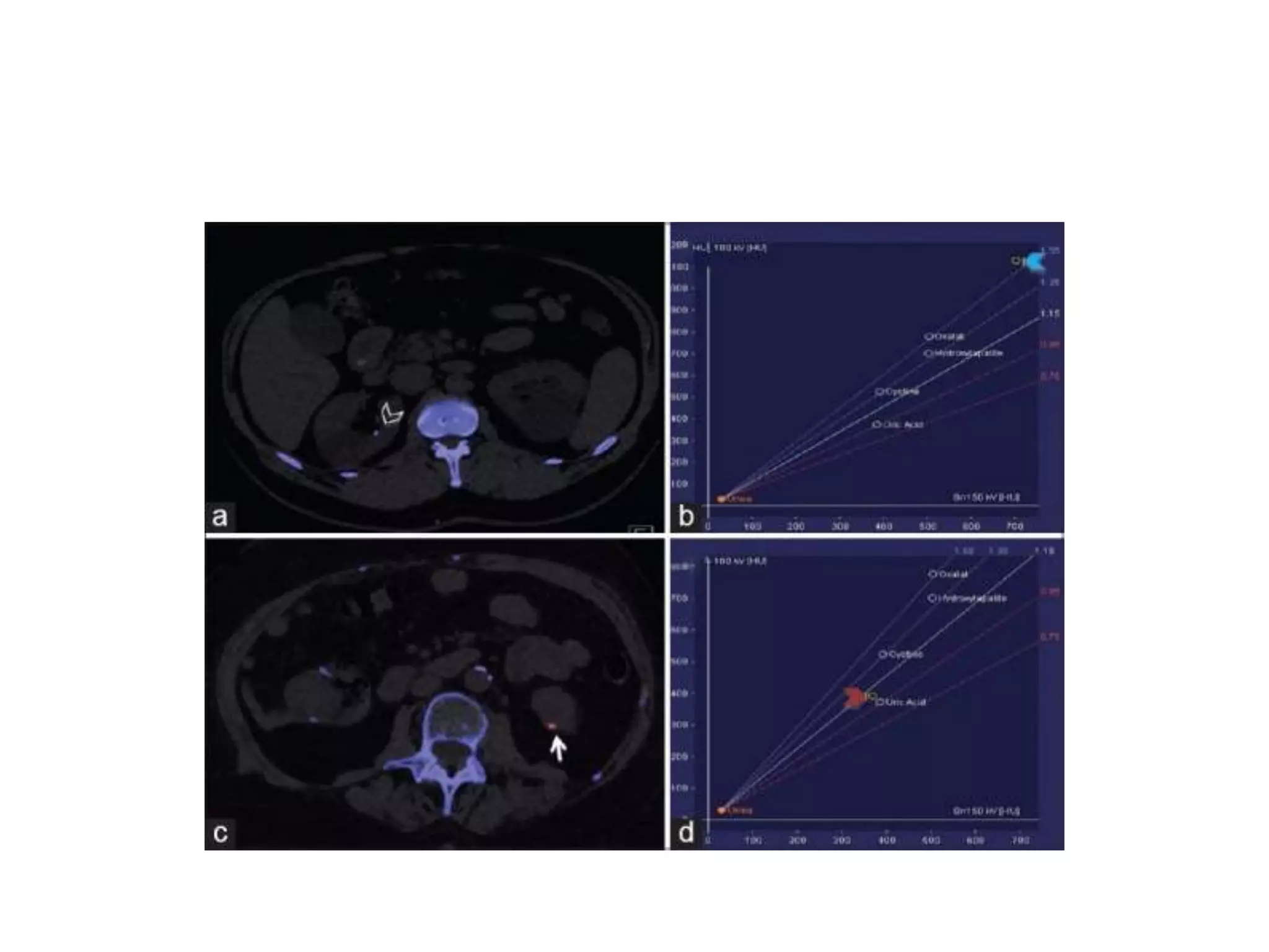 Metabolic workup & medical management of urolithiasis | PPTX