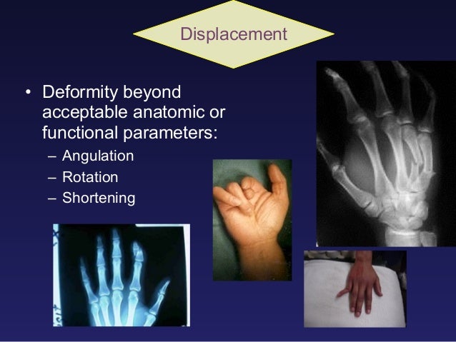 Metacarpal Fractures