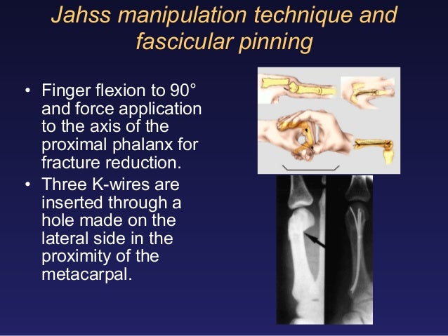 Metacarpal fractures