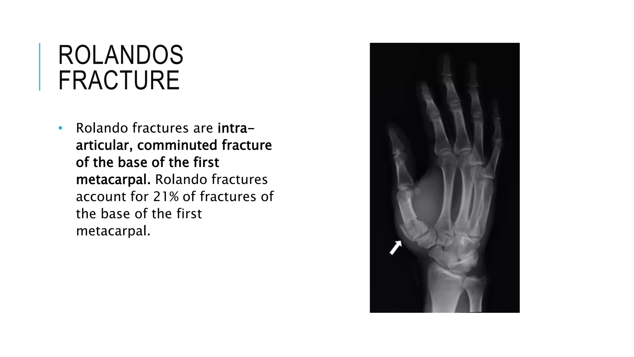 metacarpals & phalanges fractures.pptx