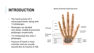 metacarpals & phalanges fractures.pptx