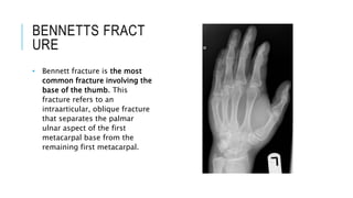 metacarpals & phalanges fractures.pptx