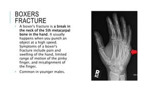 metacarpals & phalanges fractures.pptx