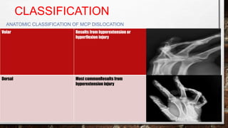 Metacarpo-phalyngeal joint dislocation.pptx