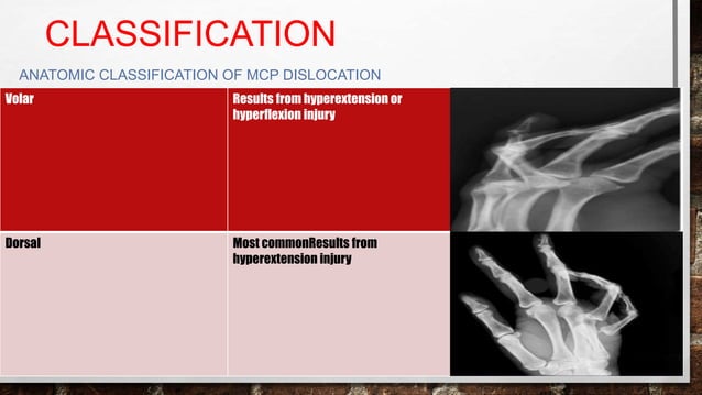Metacarpo-phalyngeal joint dislocation.pptx