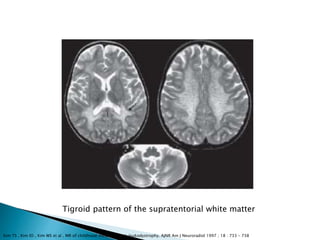 Metachromatic Leukodystrophy | PPTX