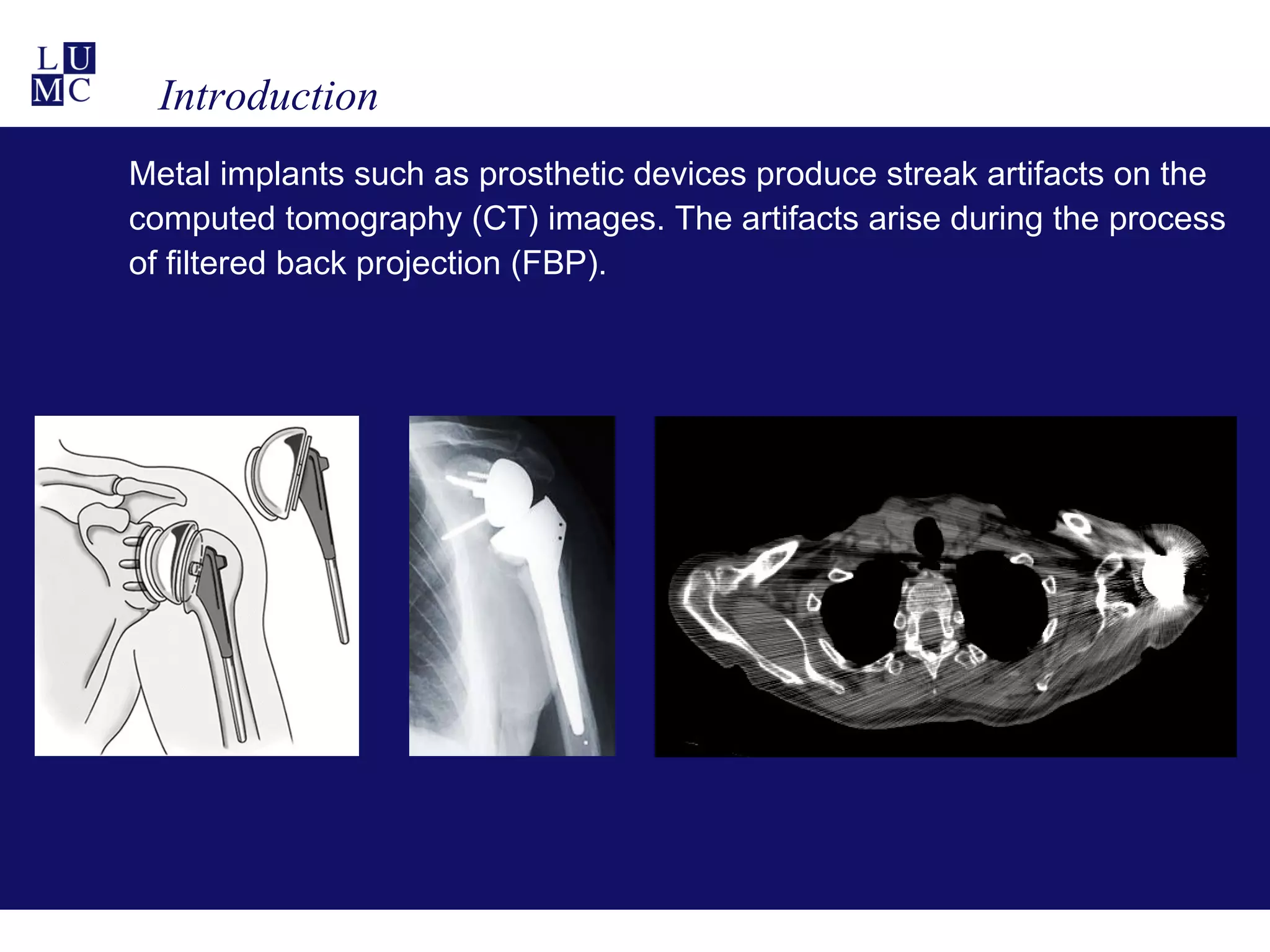 Metal artifact reduction | PPT