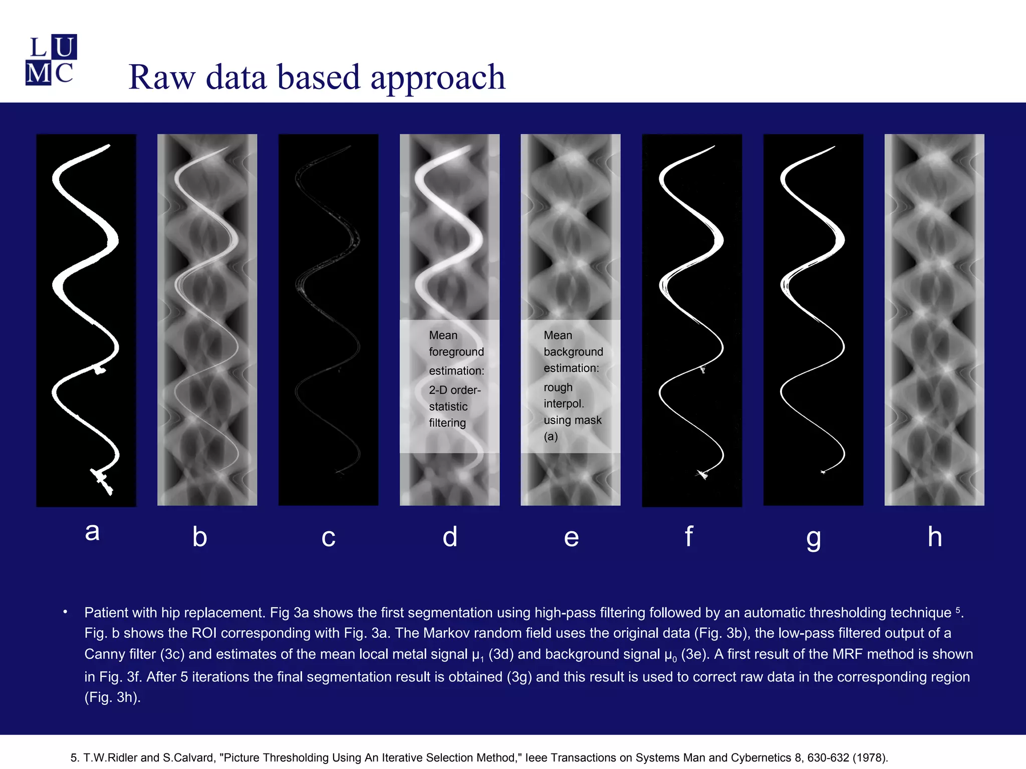 Metal artifact reduction | PPT