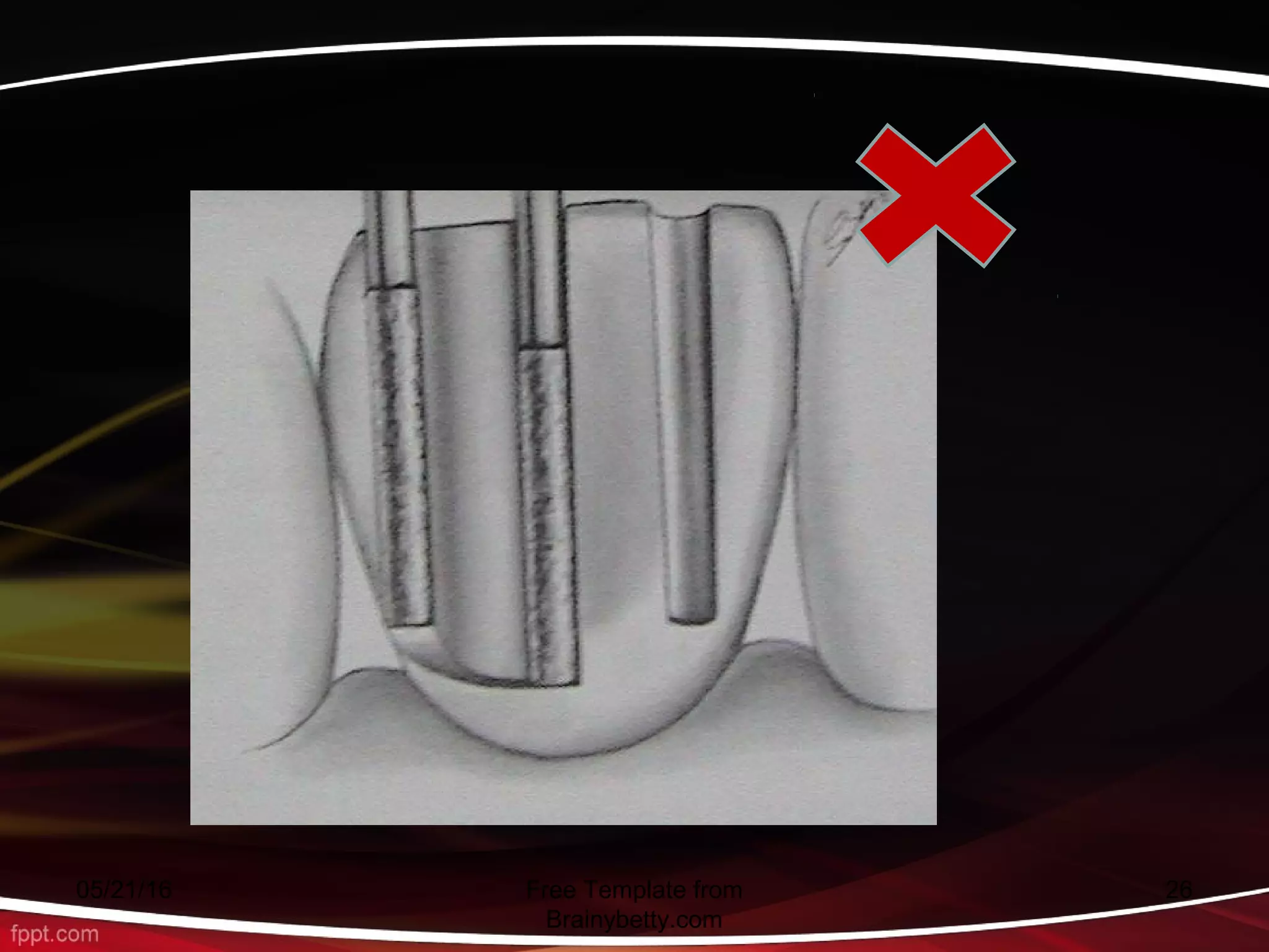 Tooth preparation for Metal ceramic crowns. | PPT