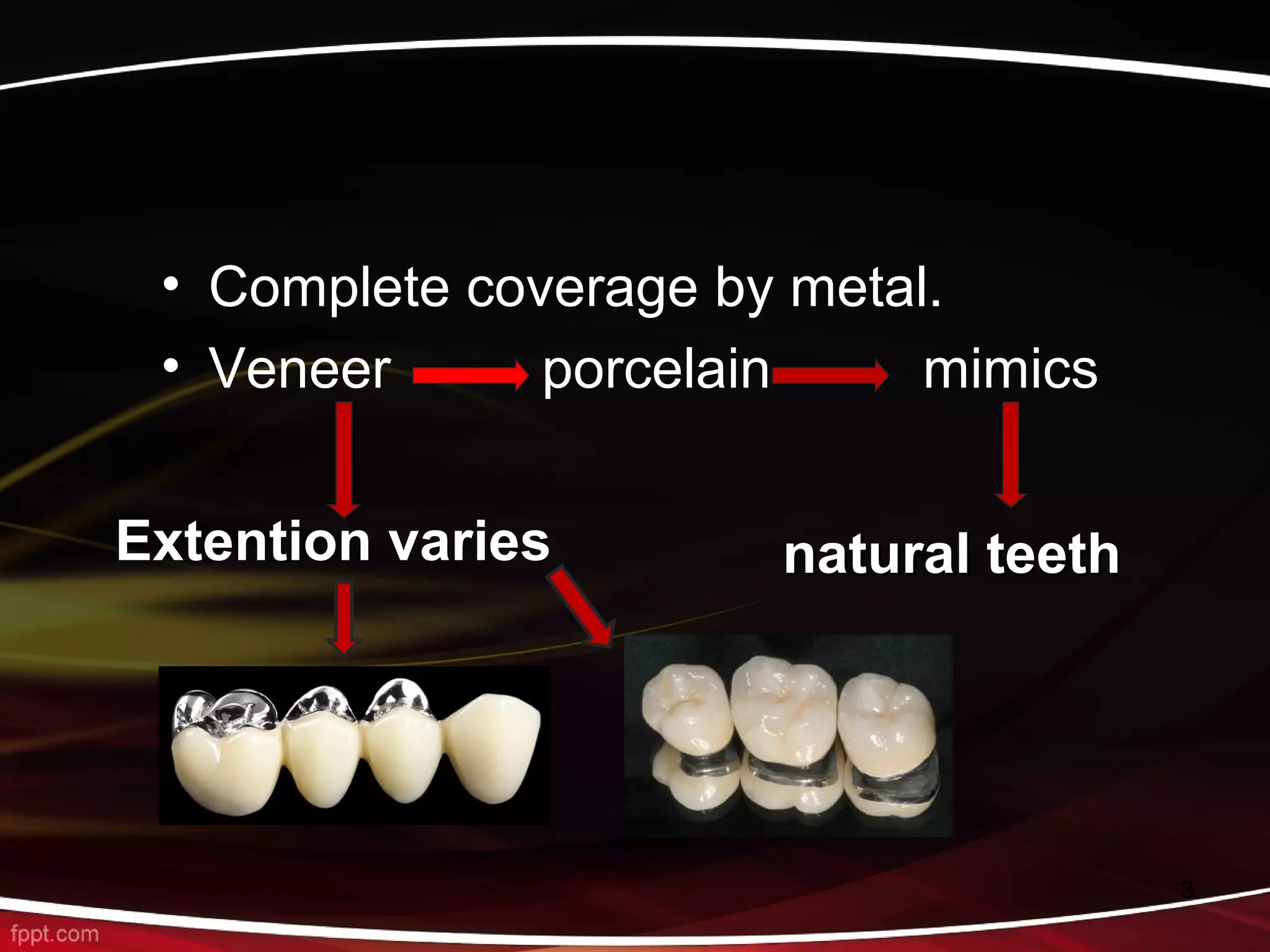 Tooth preparation for Metal ceramic crowns. | PPT