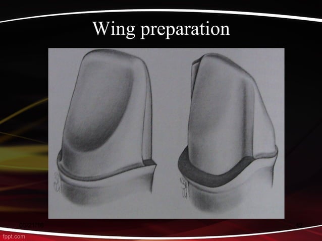Tooth preparation for Metal ceramic crowns. | PPT | Dental Health ...