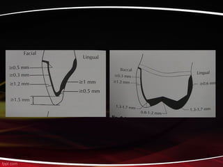 All Ceramic Crown Preparation