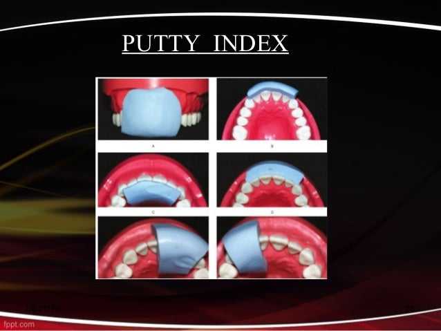 Tooth preparation for Metal ceramic crowns.
