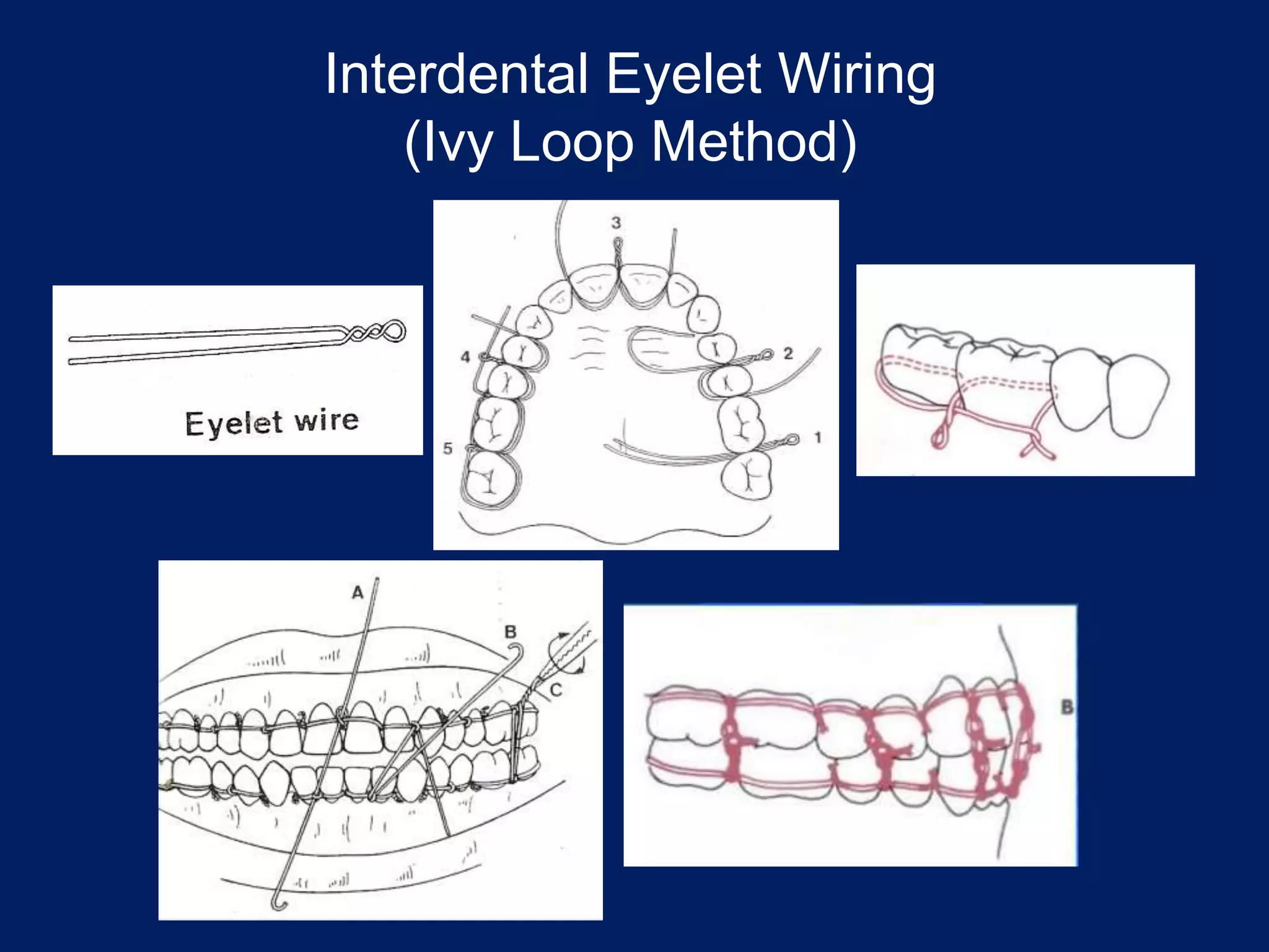 Metallurgy & fixation methods | PPTX