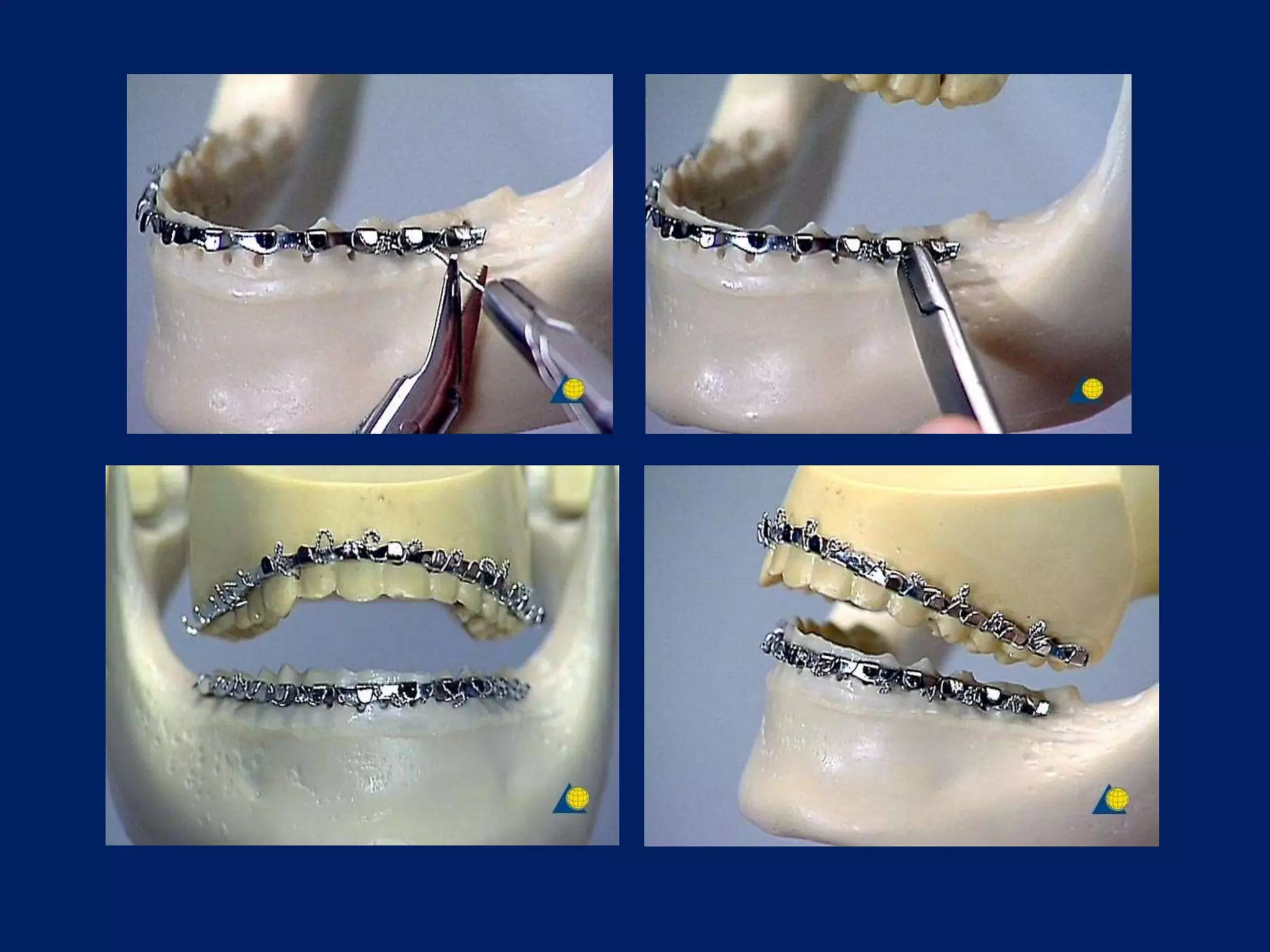 Metallurgy & fixation methods | PPTX