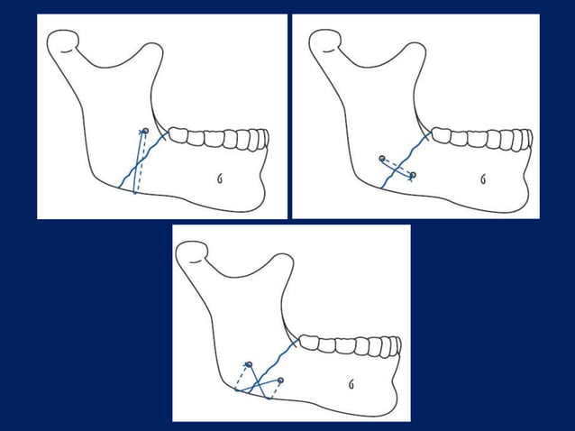 Metallurgy & fixation methods | PPT