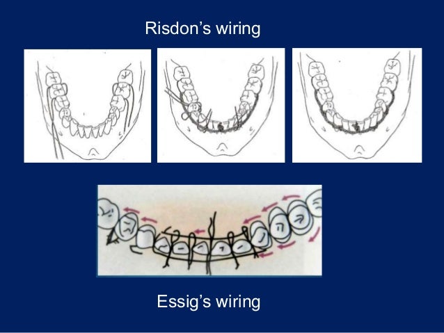 Metallurgy & fixation methods