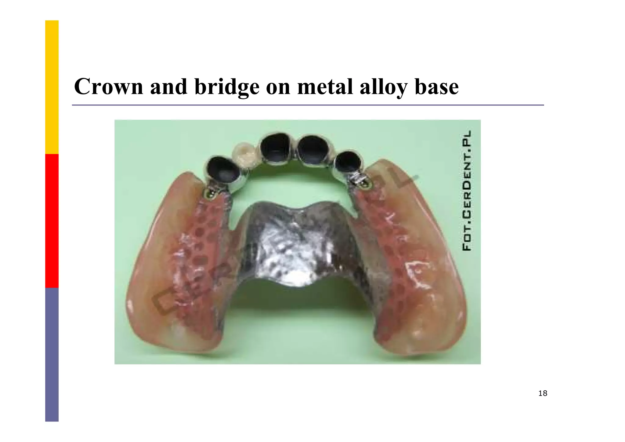 Metals in dentistry | PDF