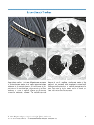 Metaphorical signs in computed tomography of chest and abdomen 2014 | PDF