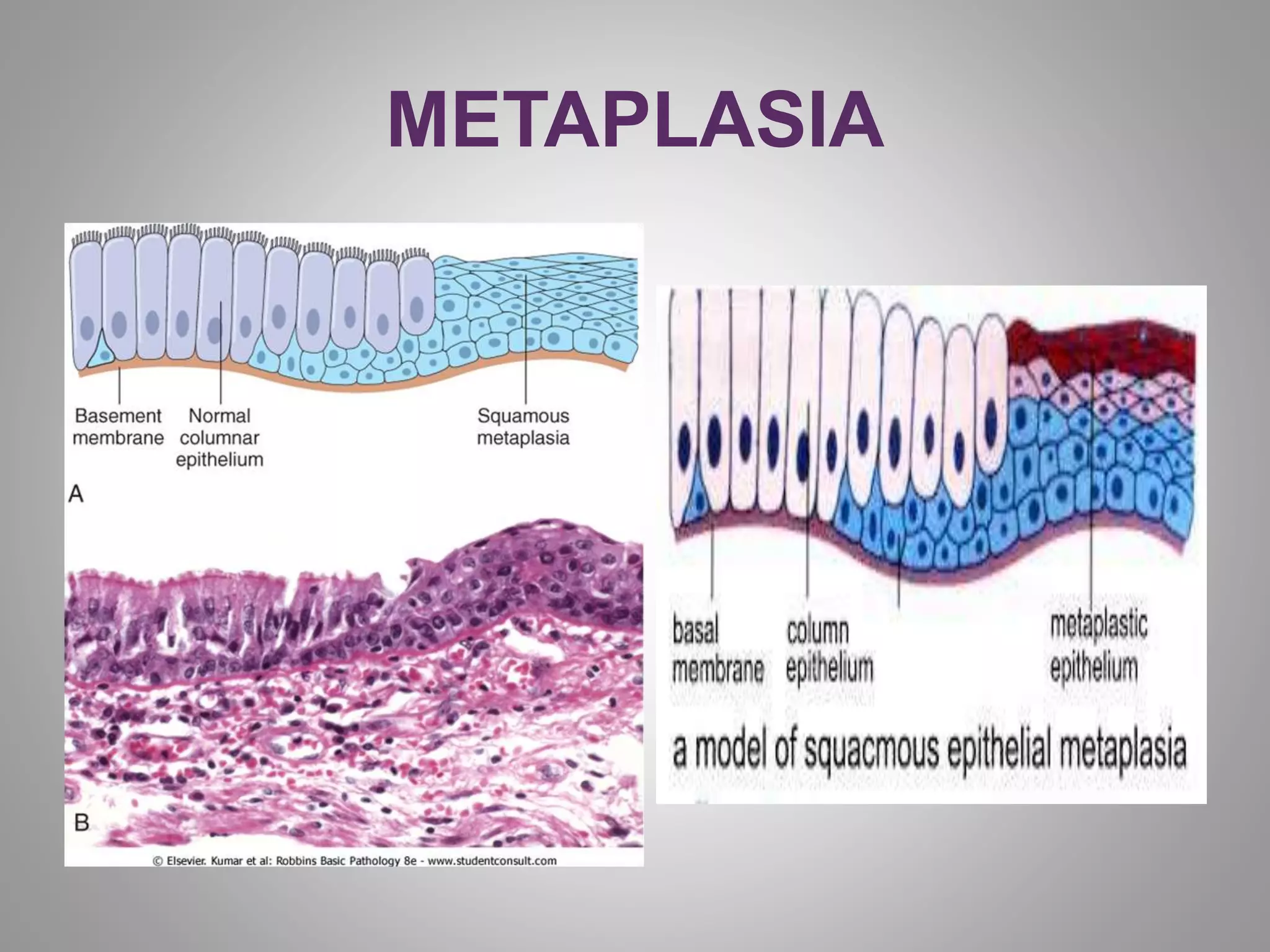 Metaplasia | PPTX