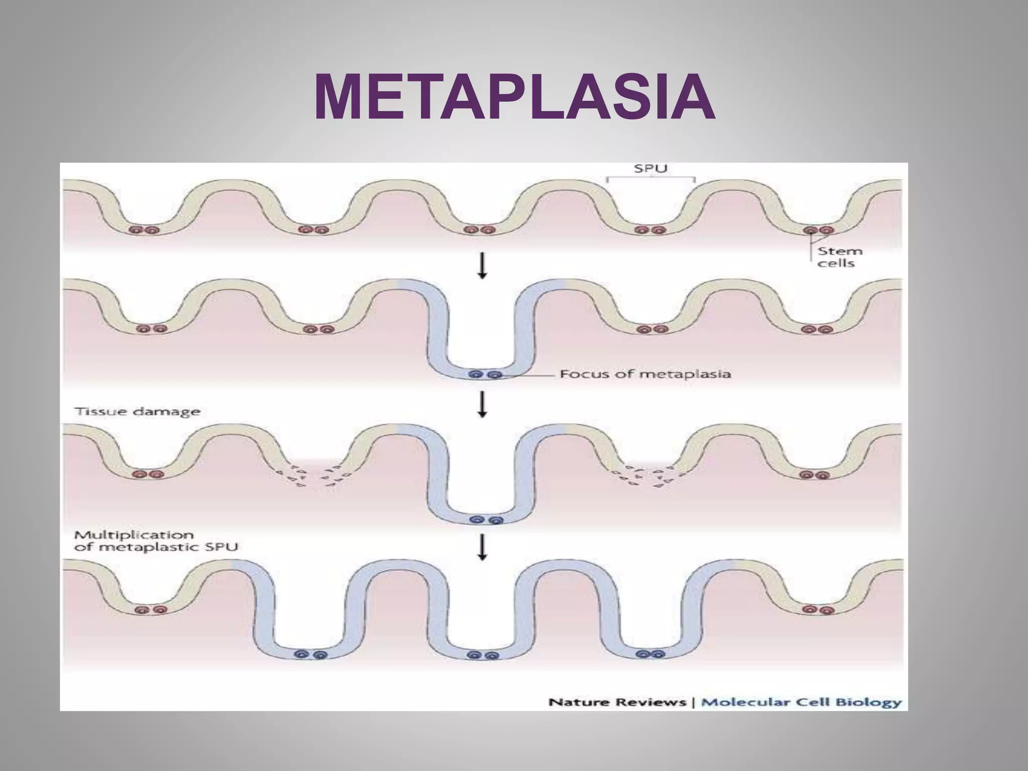 Metaplasia | PPTX