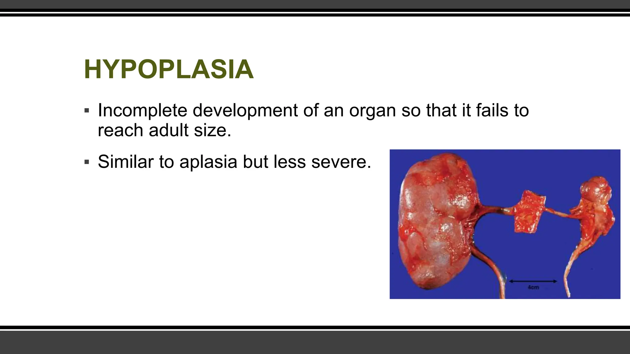 metaplasia PATHOLOGY BY TALHA SHAHID.pptx