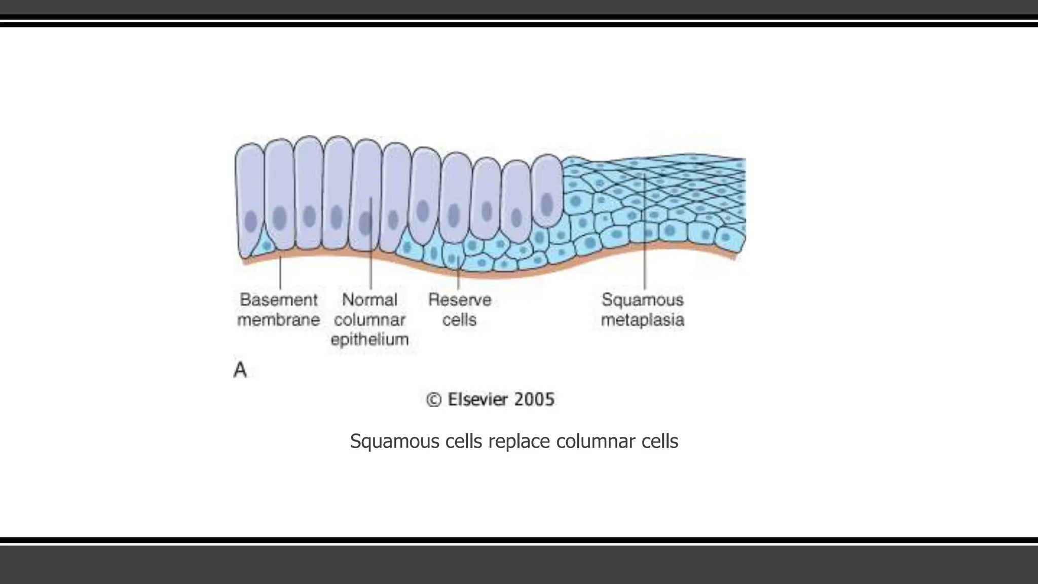 Metaplasia Pathology By Talha Shahidpptx