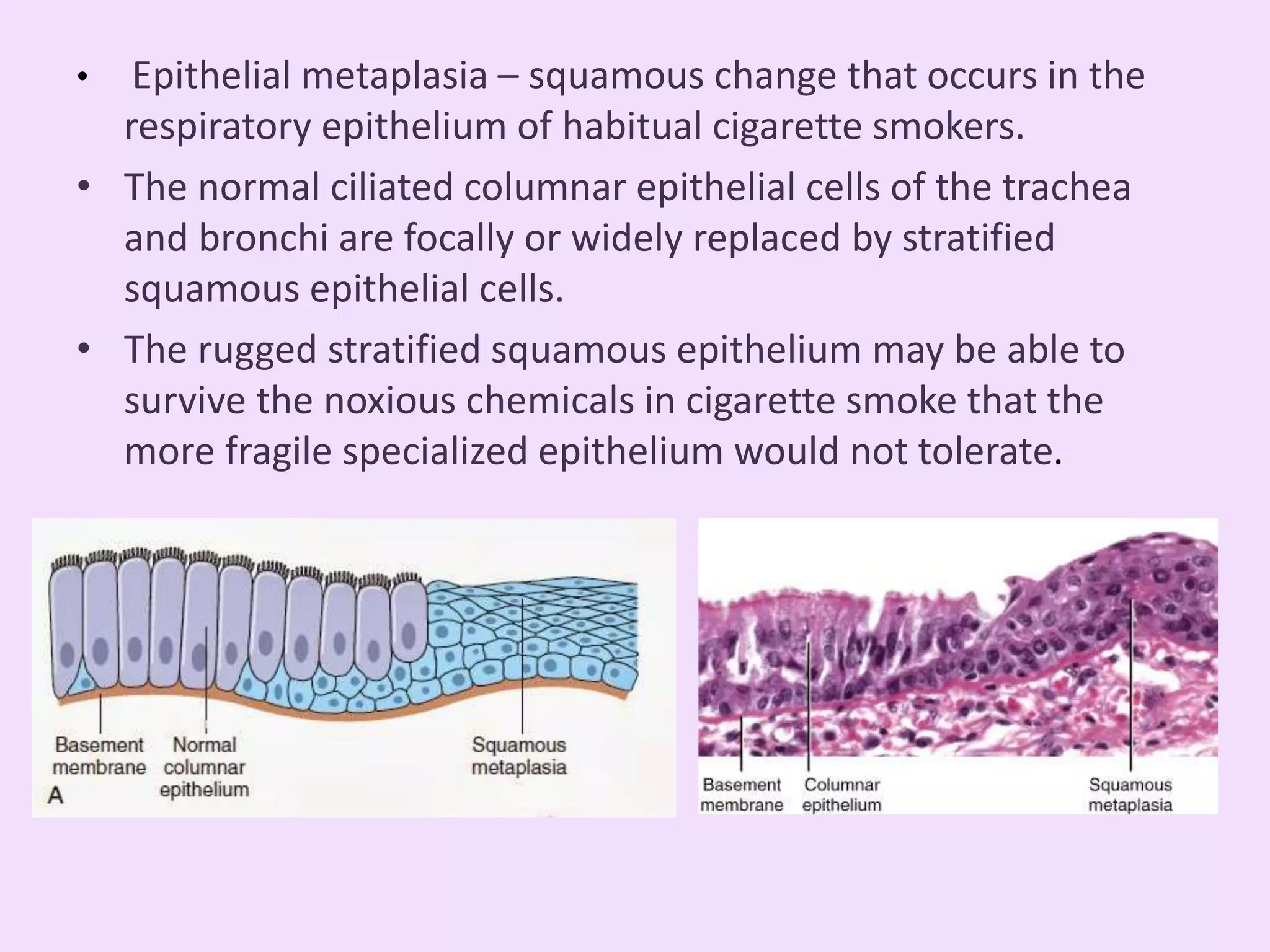 Metaplasia & Dysplasia | PPTX