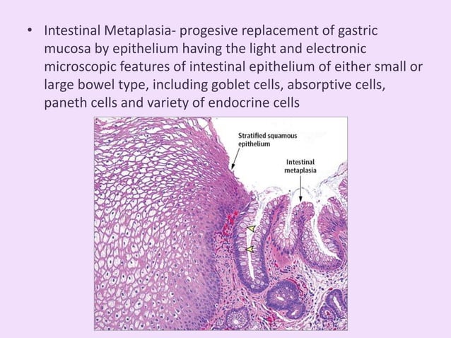 Metaplasia & Dysplasia | PPTX