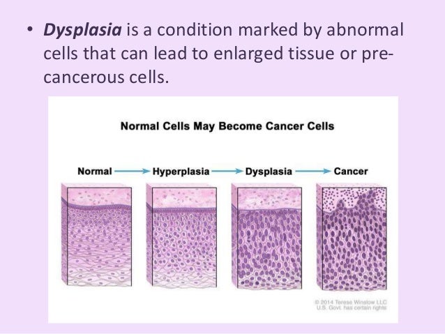 Metaplasia And Dysplasia