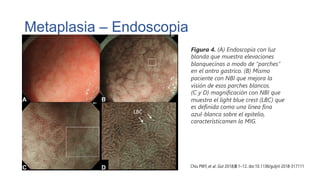 Metaplasia Intestinal Gastrica | PDF