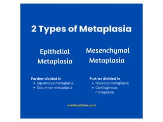 Metaplasia Pathology, Definition, Types, Causes and Examples | PPTX