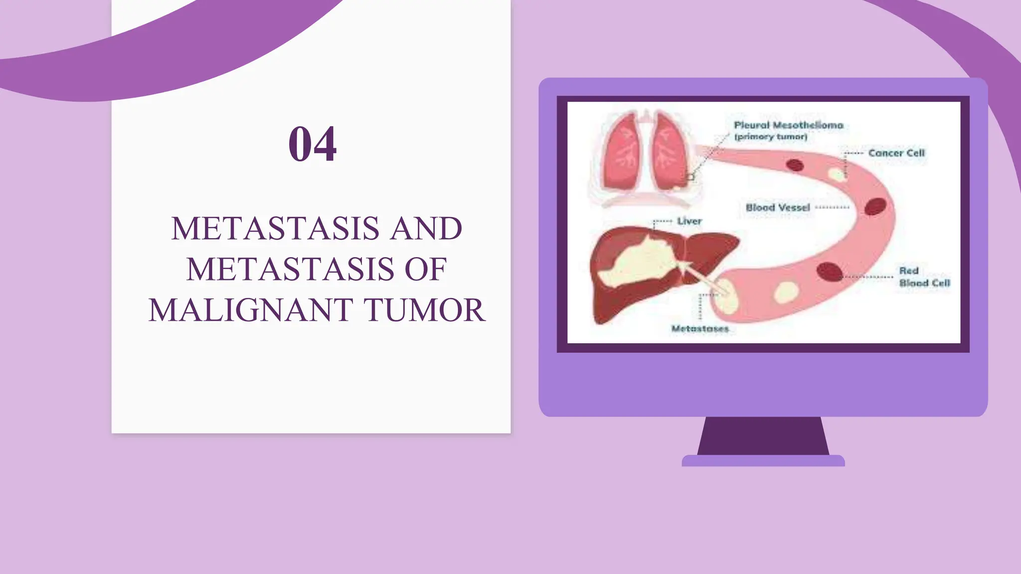 METASIS OF MALIGNANT TUMOR.pptx