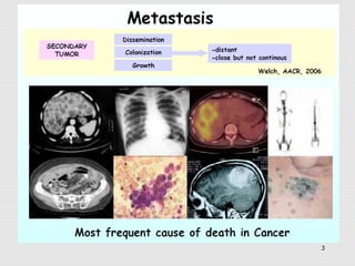 Metastasis | PPT
