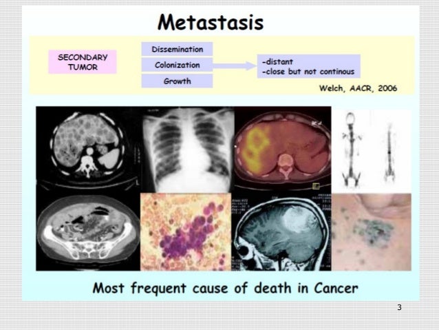 Metastasis