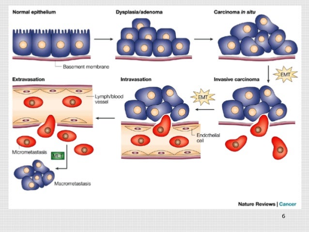 Stages Of Tumor Development And Mechanism Of Metastasis Download
