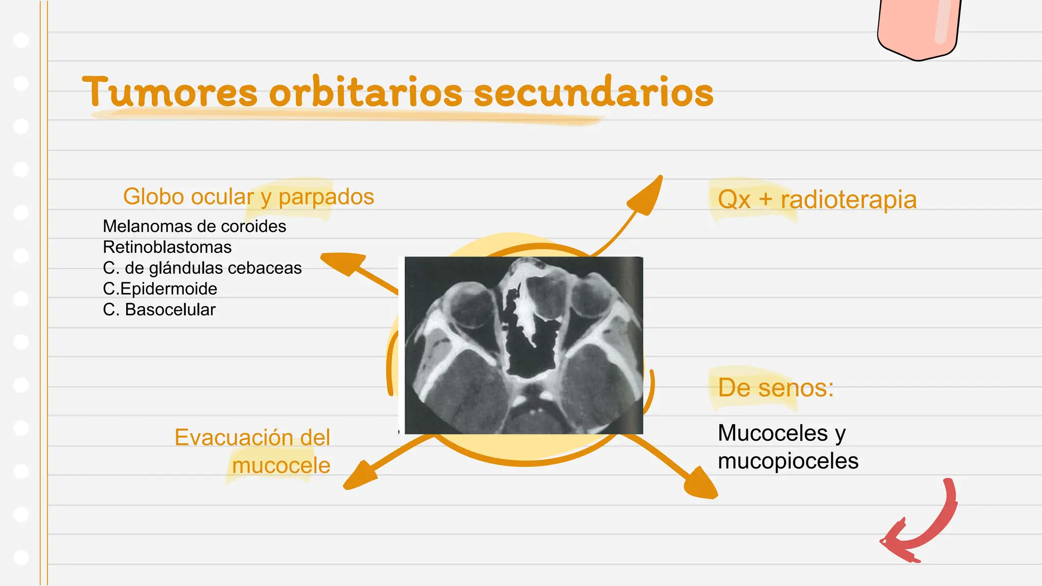 Tumores orbitarios malignos | PPT