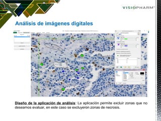 Metastasis cerebral y proliferación | PPT