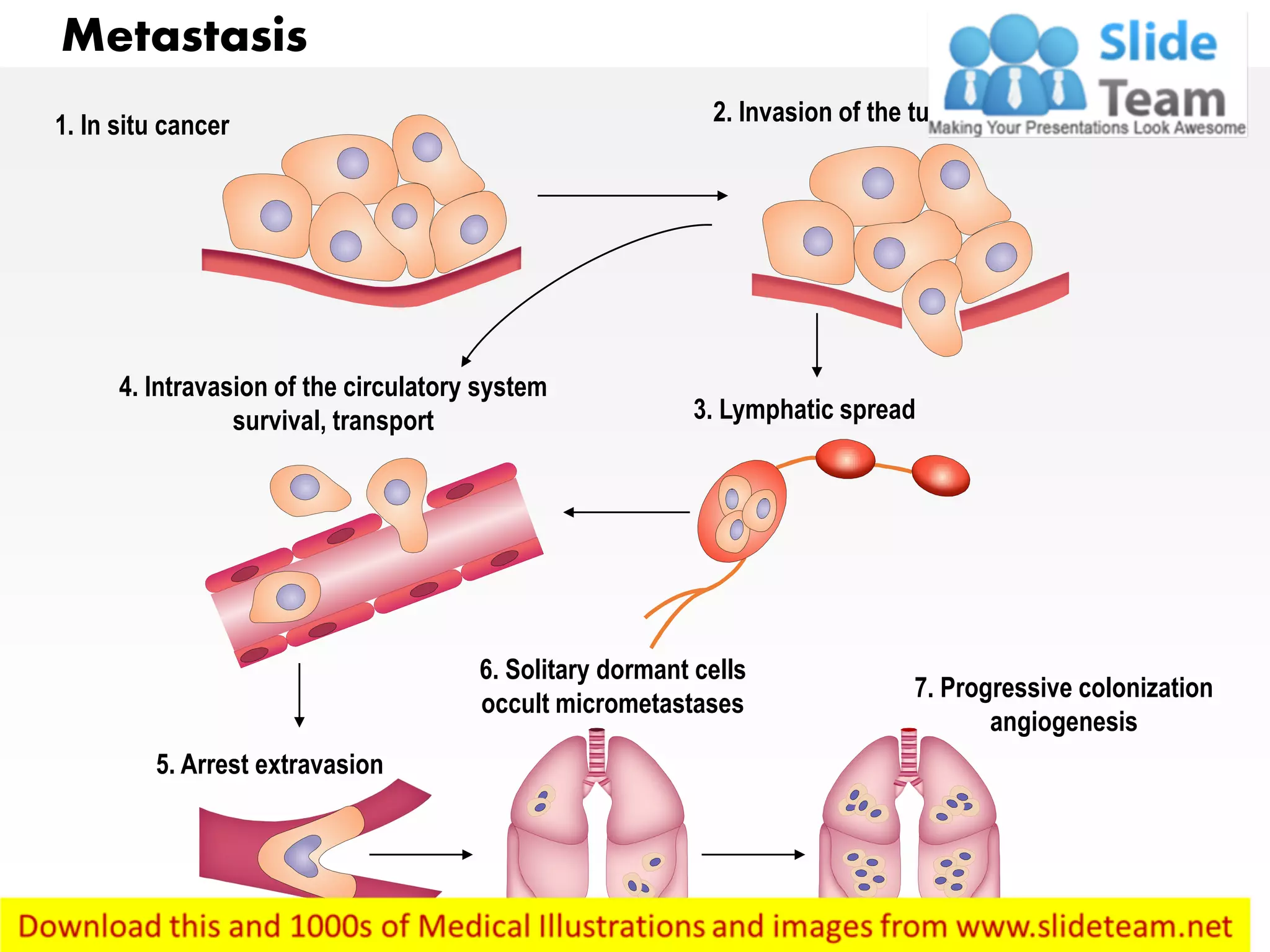 Metastasis medical images for power point | PDF