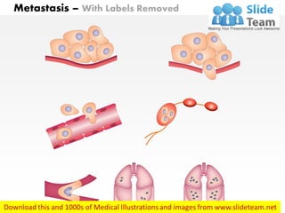Metastasis medical images for power point | PDF