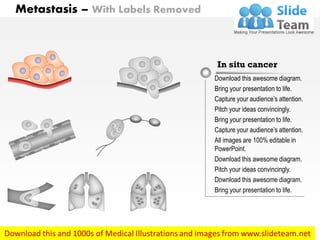 Metastasis medical images for power point | PDF