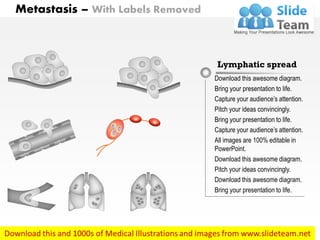 Metastasis medical images for power point | PDF