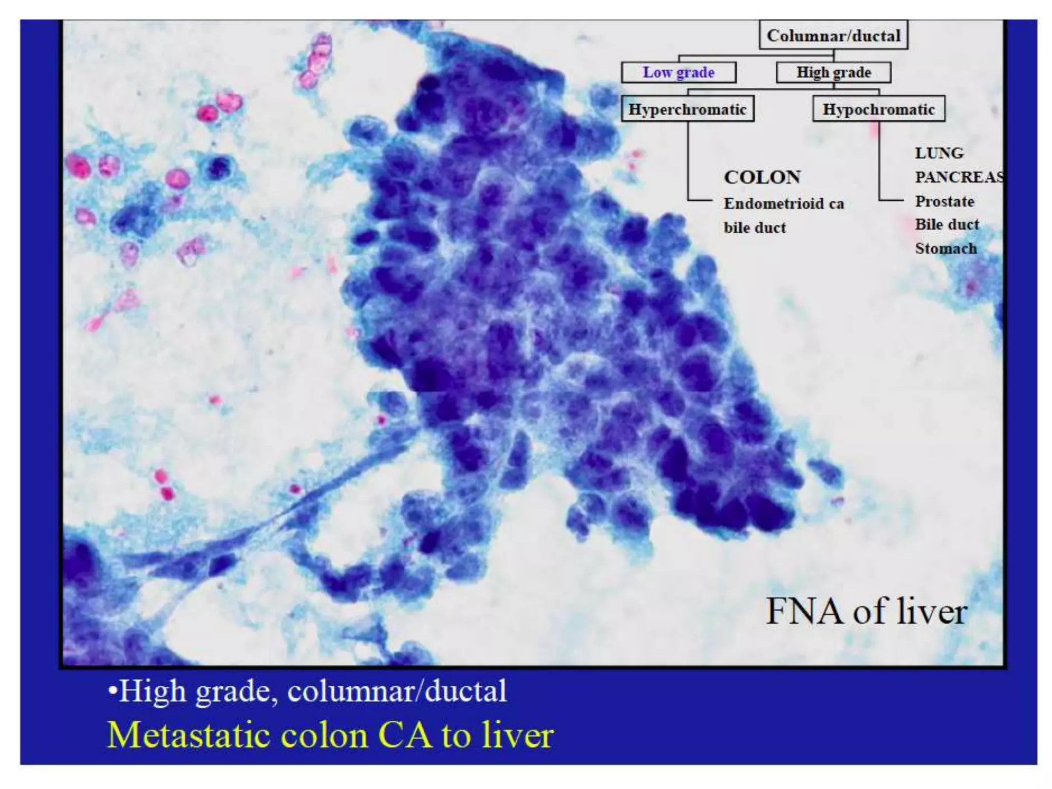 Metastasis pg activity | PPT
