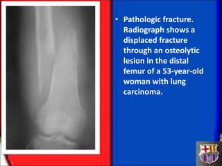 metastatic-bone-tumor.ppt