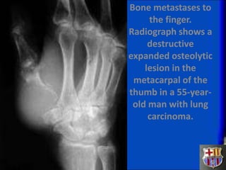 metastatic-bone-tumor.ppt