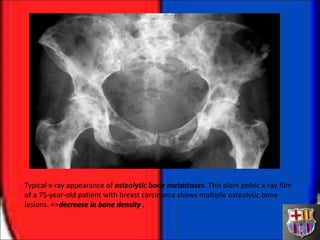 metastatic-bone-tumor.ppt